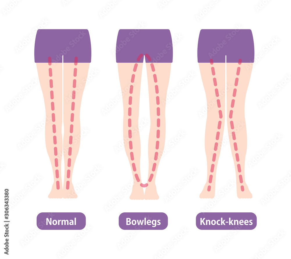 Poster Difference types of legs angles and knees vector illustration ...