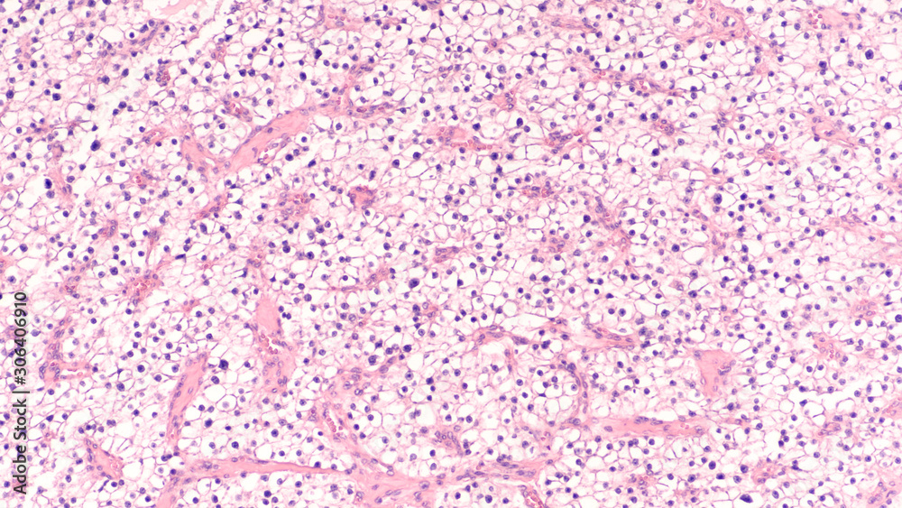 Microscopic image showing histology of a parathyroid adenoma, water ...