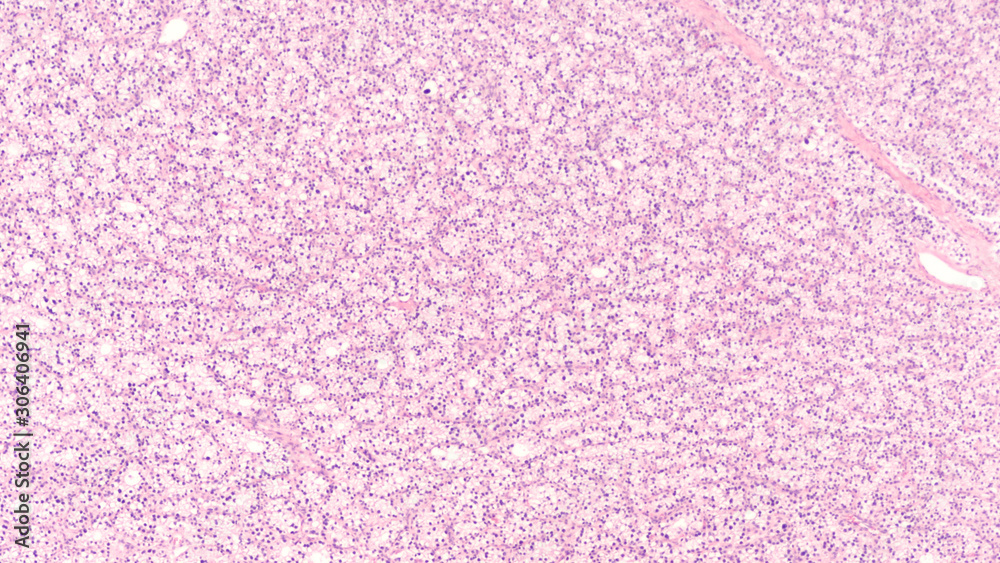 Microscopic image showing histology of a parathyroid adenoma, water ...