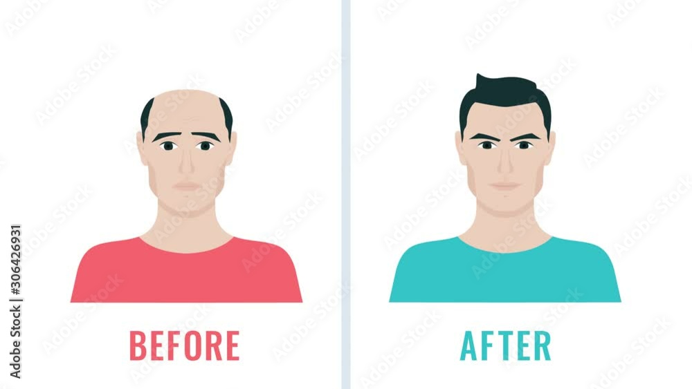 Before And After Hair Transplantation Treatment Cartoon Animation