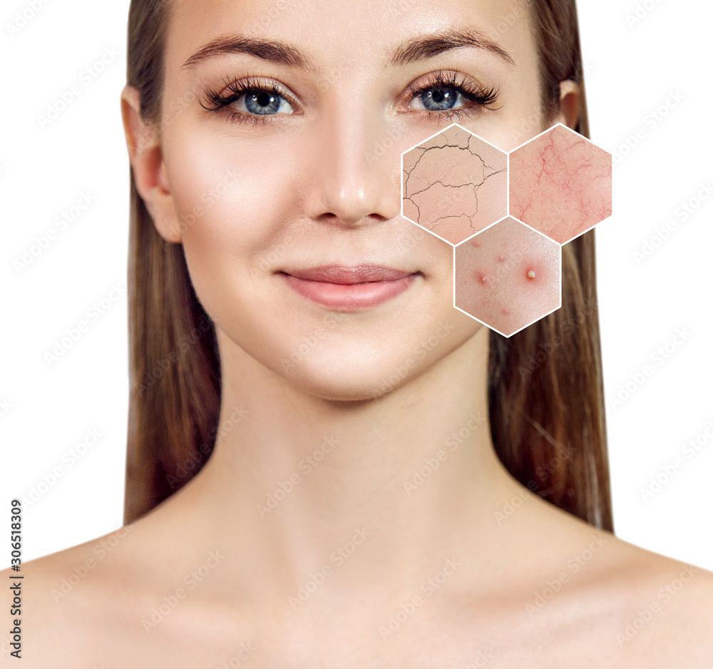 Zoom hexagon shows skin problems with couperose and acne. Stock Photo ...