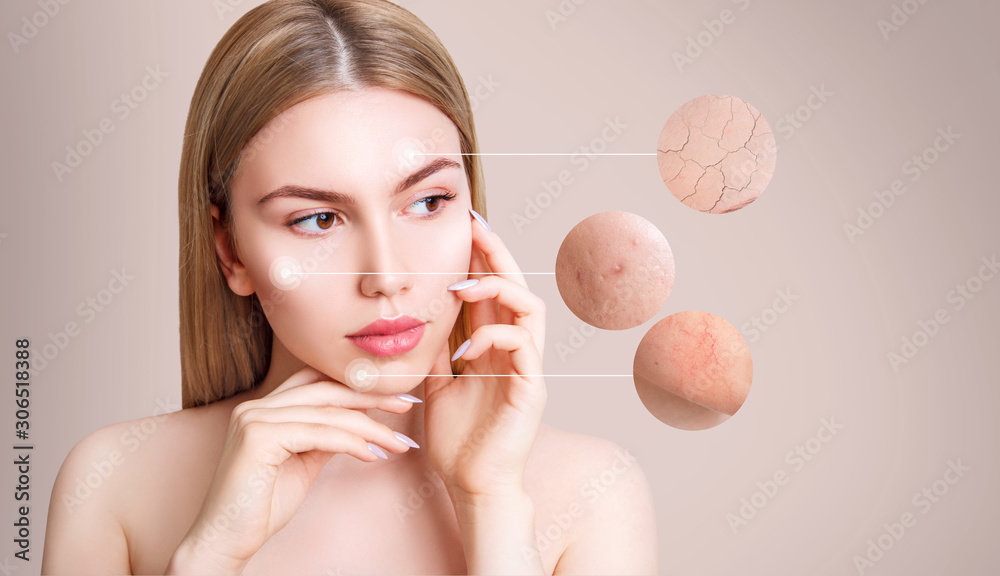 Magnifying circles demonstrate couperose and acne on face skin of young ...