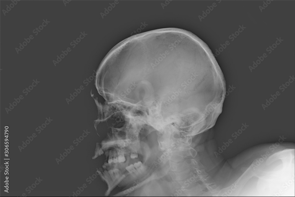 radiography of the skull in the lateral projection fractures of the ...