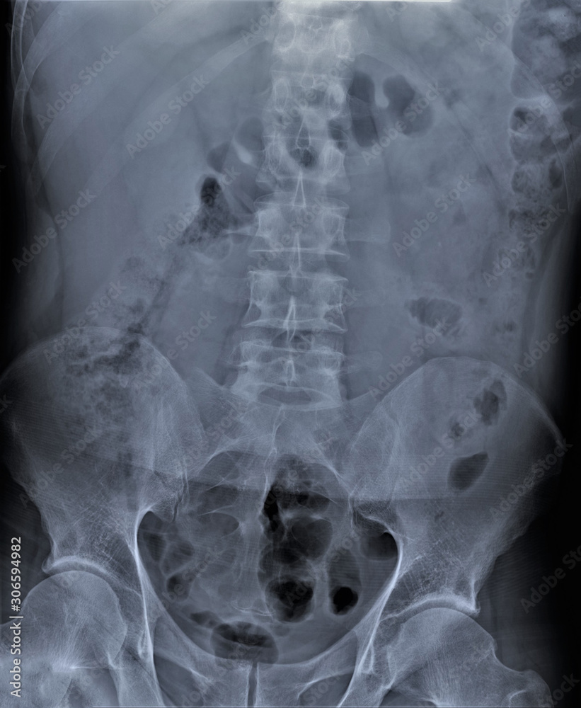 radiography of lumbar and sacral spine, pelvis, coxarthrosis, medical ...