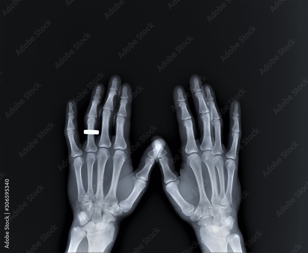 normal x-ray of the hand bones and fingers,orthopedics, medical ...