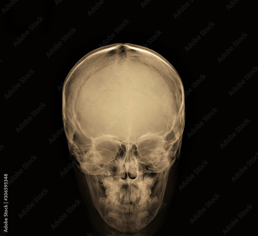 radiography of yellow skull in direct projection, medical diagnostics ...