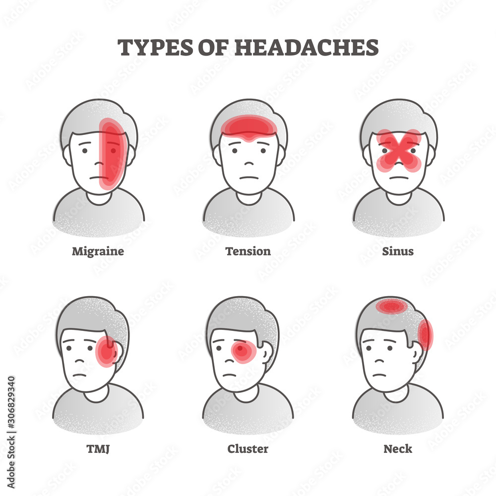 Types of headaches vector illustration. Labeled educational brain pain ...