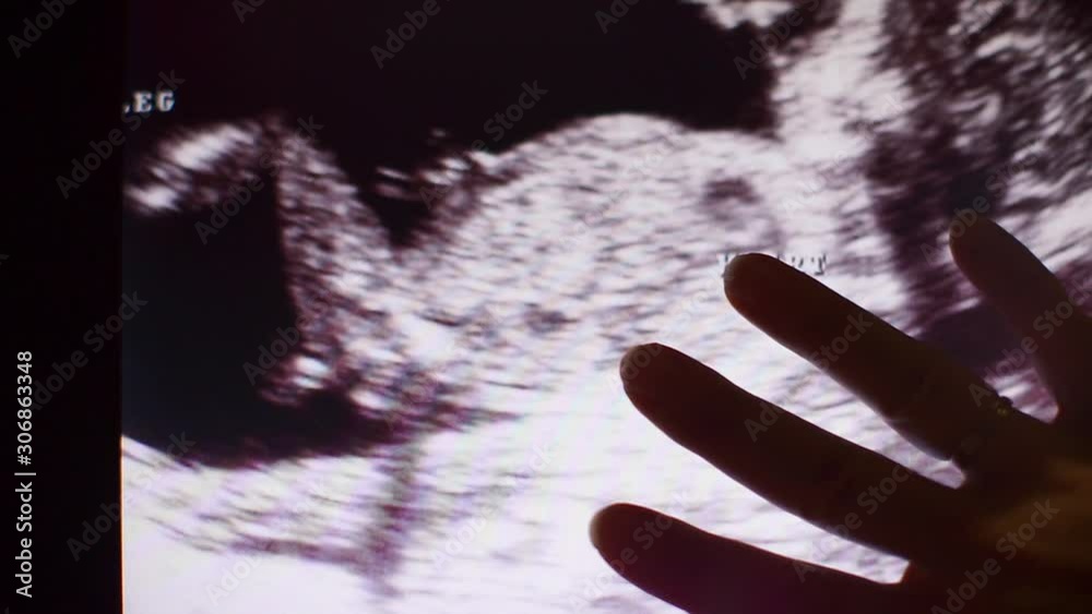 Black and white photo of an ultrasound scan of an embryo of a human ...