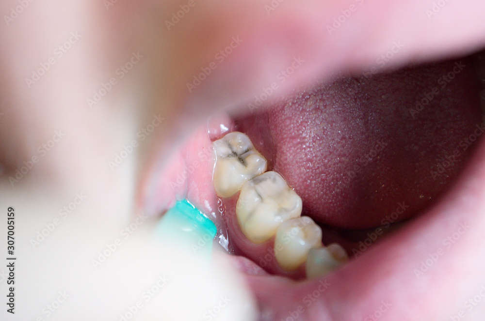 carious lesions on chewing teeth, dental caries, aesthetic defect ...