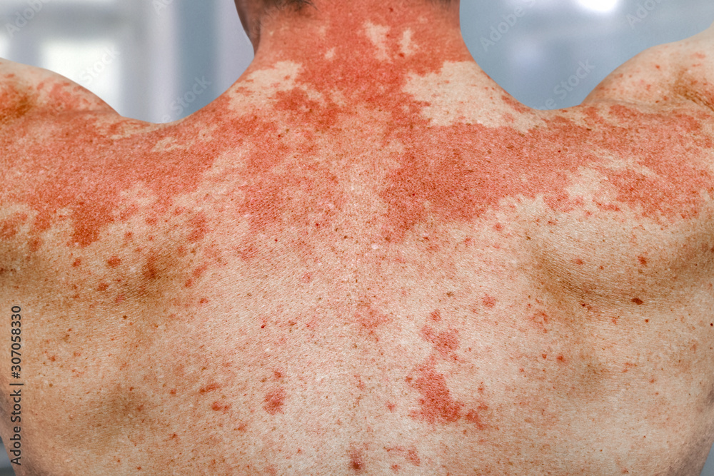 Skin allergy on the human body. Skin diseases. Stock Photo | Adobe Stock