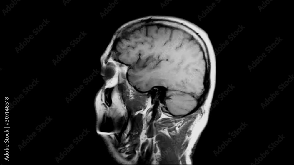 Human Brain MRI Scan, X-ray - Magnetic Resonance imaging of a brain ...