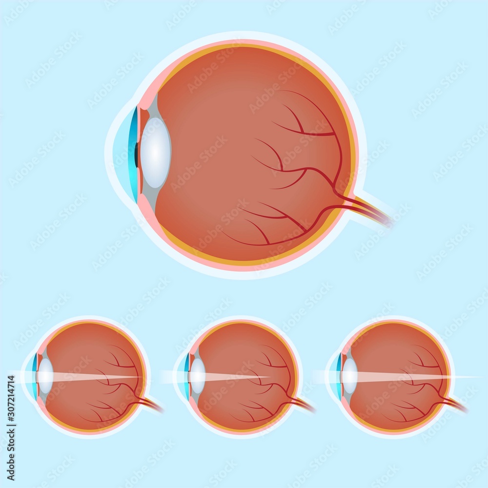 Human Eye Anatomy, Normal Eye, Myopia and Hyperopia, Visual Impairment ...