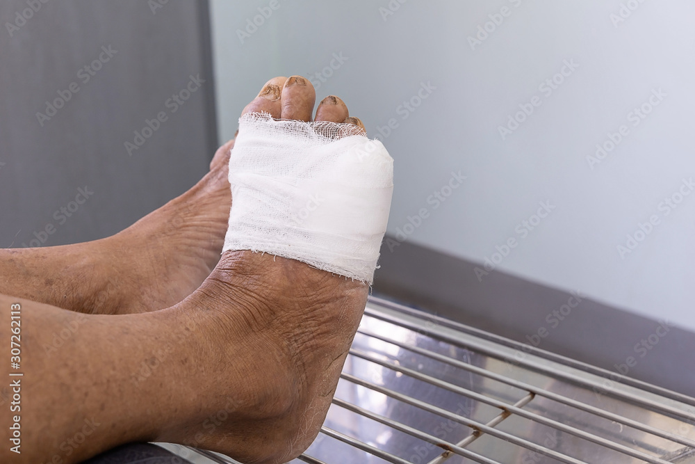 foot infected wound Stock Photo | Adobe Stock