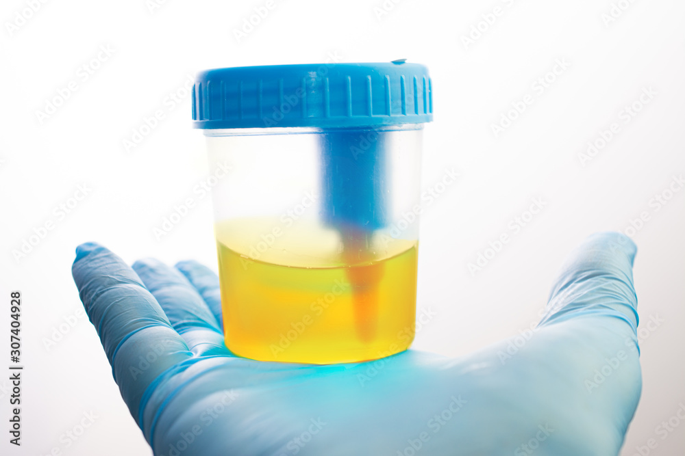 Urine analysis in the laboratory. Medical urine test. Urine sample for ...