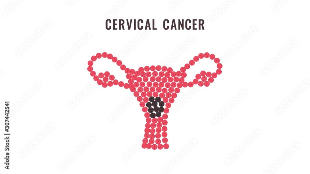 Cervical cancer animation of pills forming uterus. Disease awareness ...