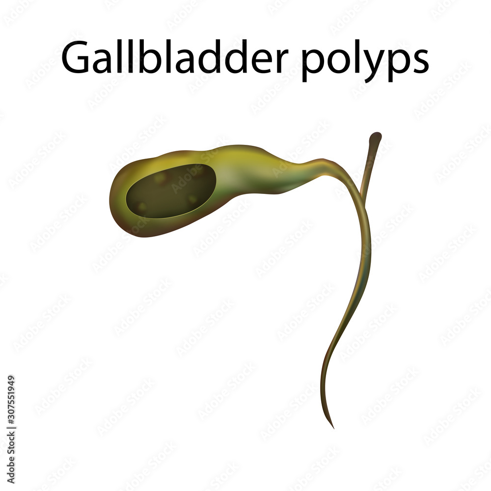Gallbladder polyps. Abnormal growth of tissue. Medical anatomy ...