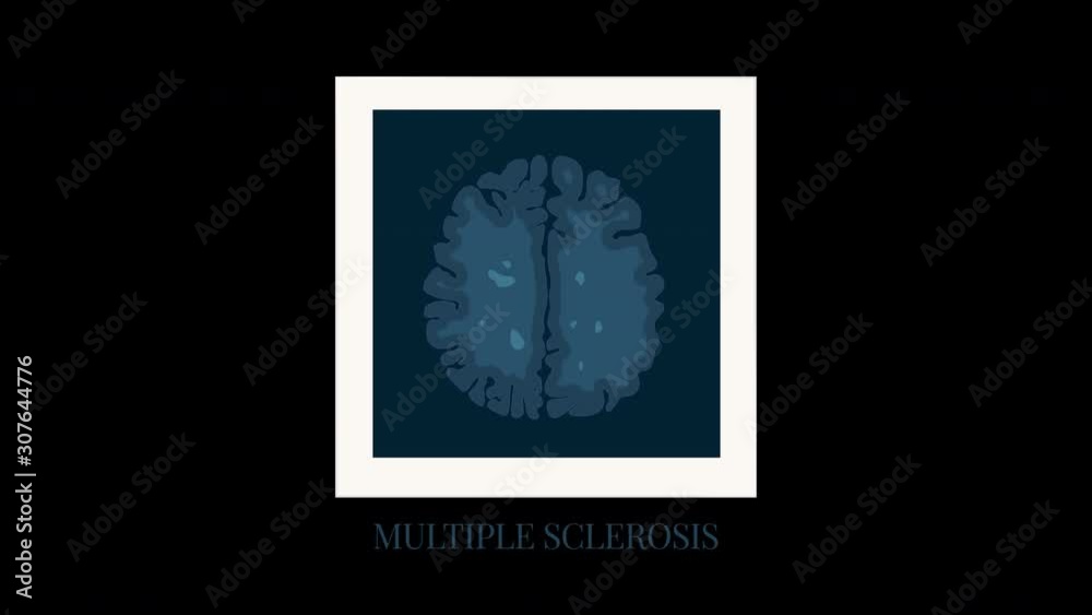 Multiple sclerosis motion graphics with MRI scan photo of brain ...