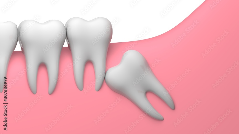 Wisdom tooth angular impaction illustration, 3D-rendering, white ...