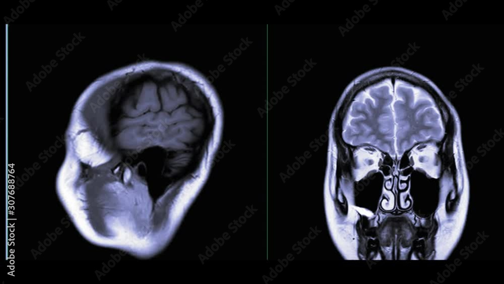 Comparison MRI of the brain sagittal and Coronal plane for detect a ...