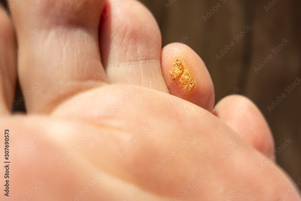 Wart (verrucae plantares) on a toe on a foot as a typical skin disease ...