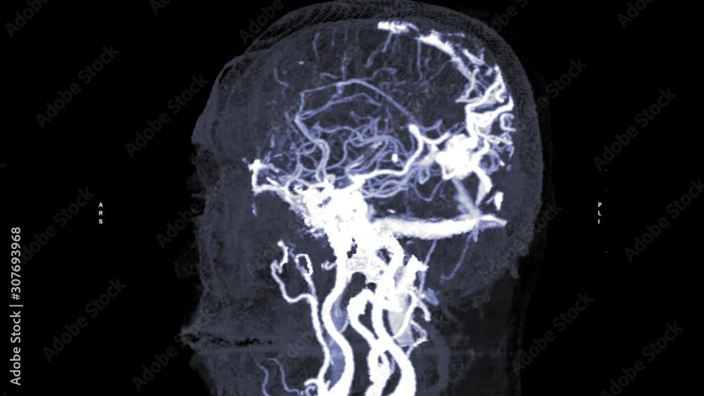 CTA Brain or computed tomography angiography of the brain 3D MIP image ...