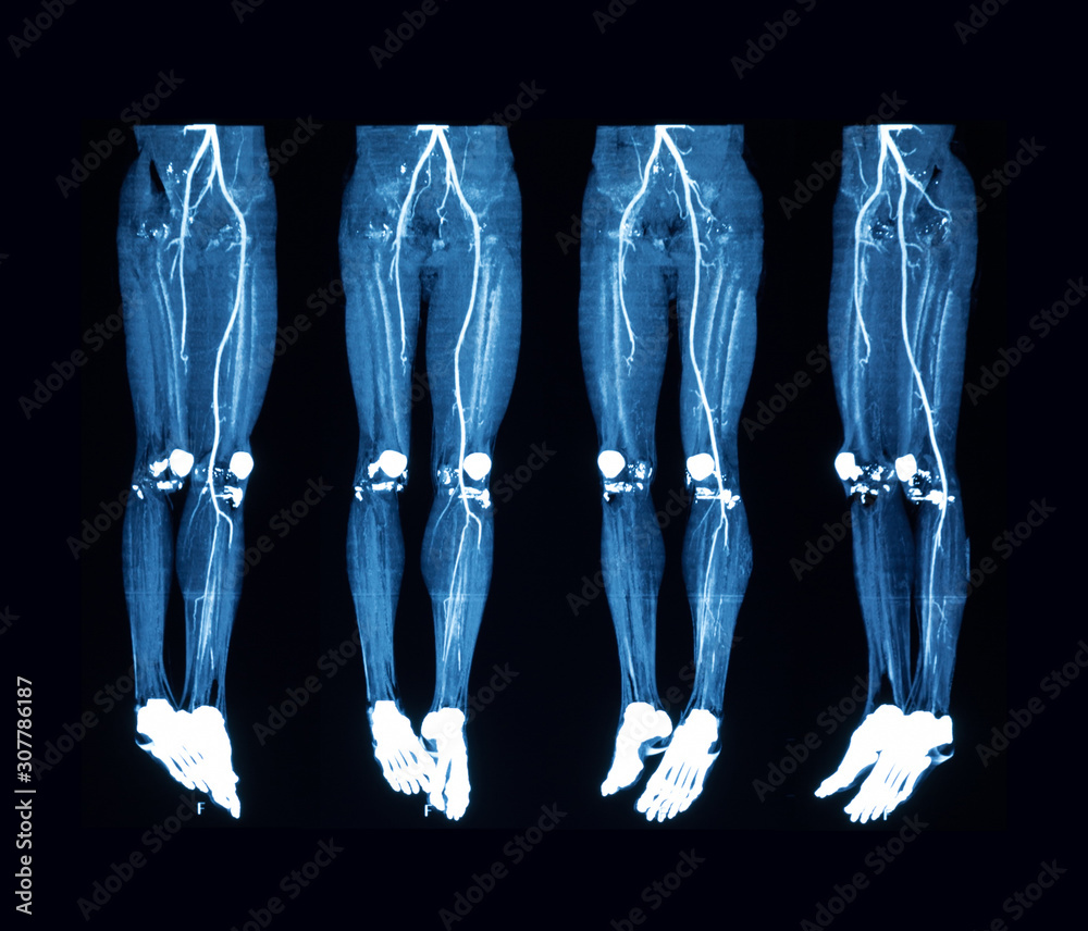 Computed tomography angiography (CTA ) of lower extremity Stock Photo ...