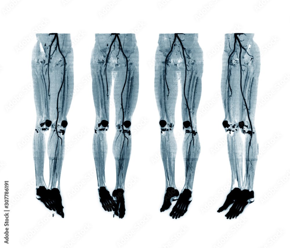 Computed tomography angiography (CTA ) of lower extremity Stock ...