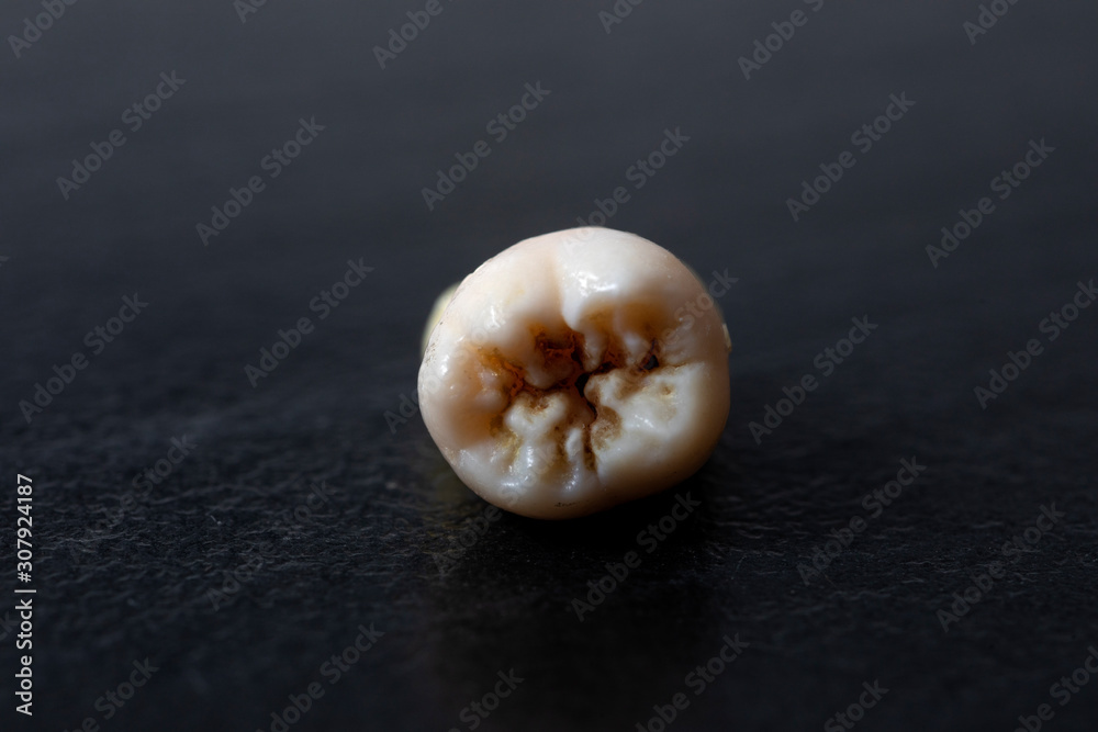 Torn out human tooth. Caries close-up. Tooth loss. Torn tooth on a ...