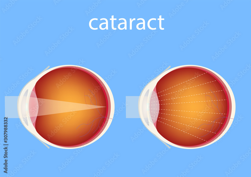 Vetor de cataract; eye; lens; diagram; structure; ball; disease ...