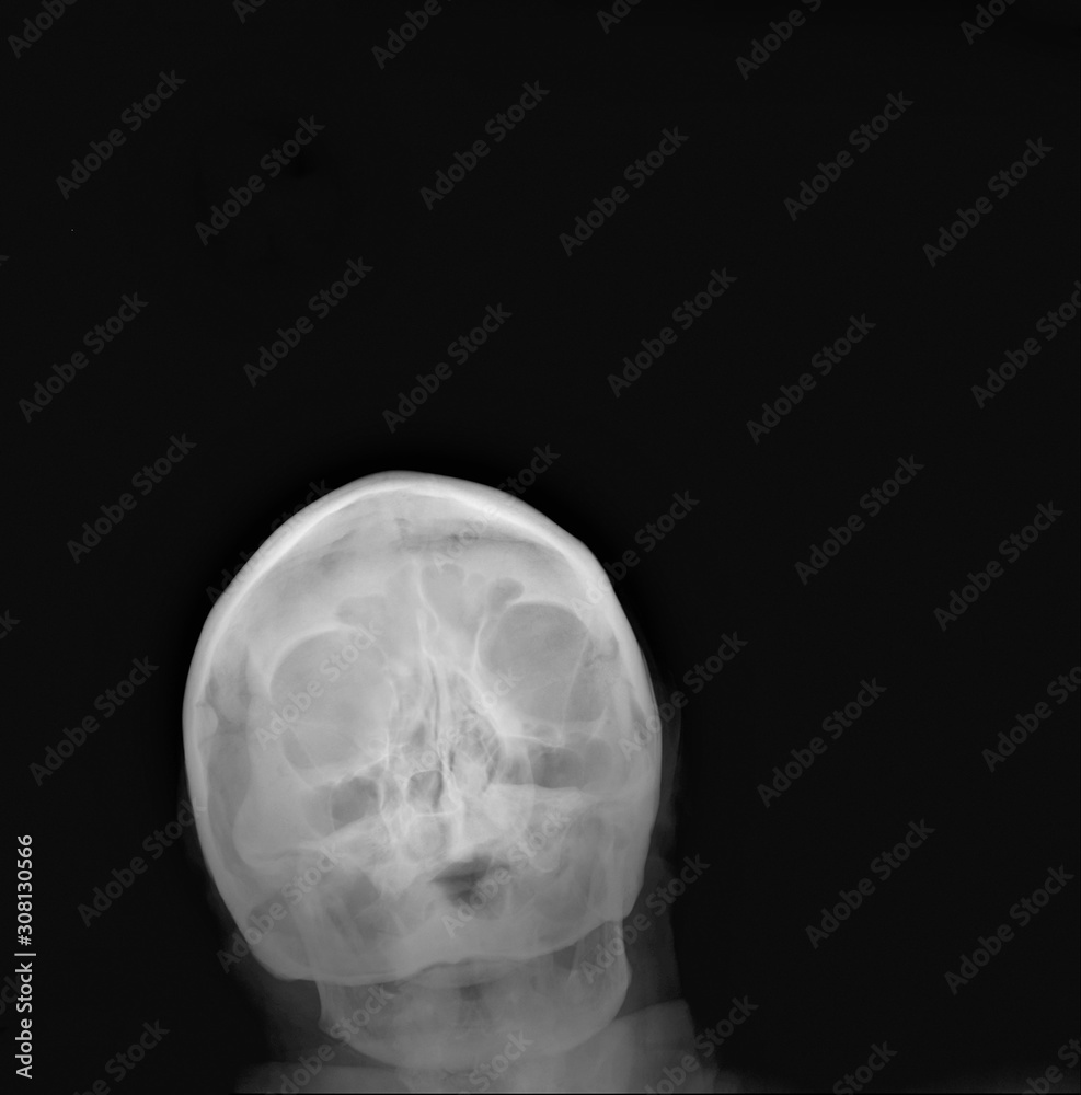 radiography of the paranasal sinuses of the skull, medical diagnosis ...
