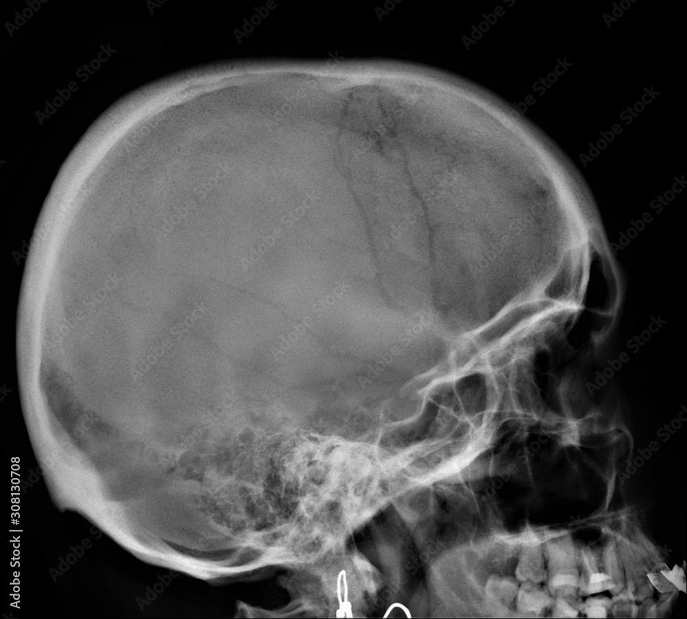 normal radiography of the skull in lateral projection, medical ...