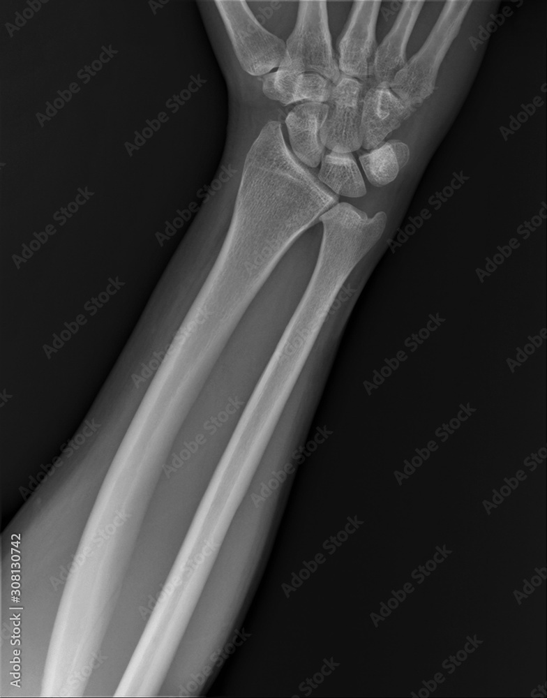 normal radiography of hand and wrist bones, traumatology and ...