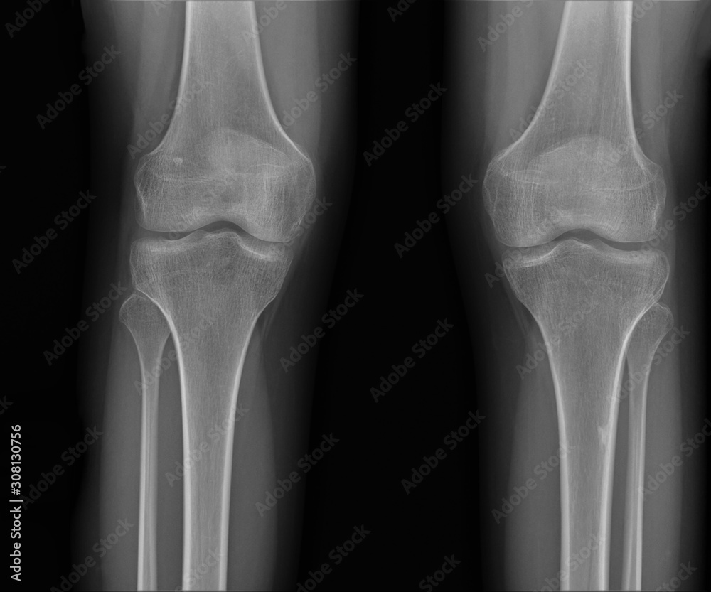 normal radiography of the knee joint in the frontal projection medical ...