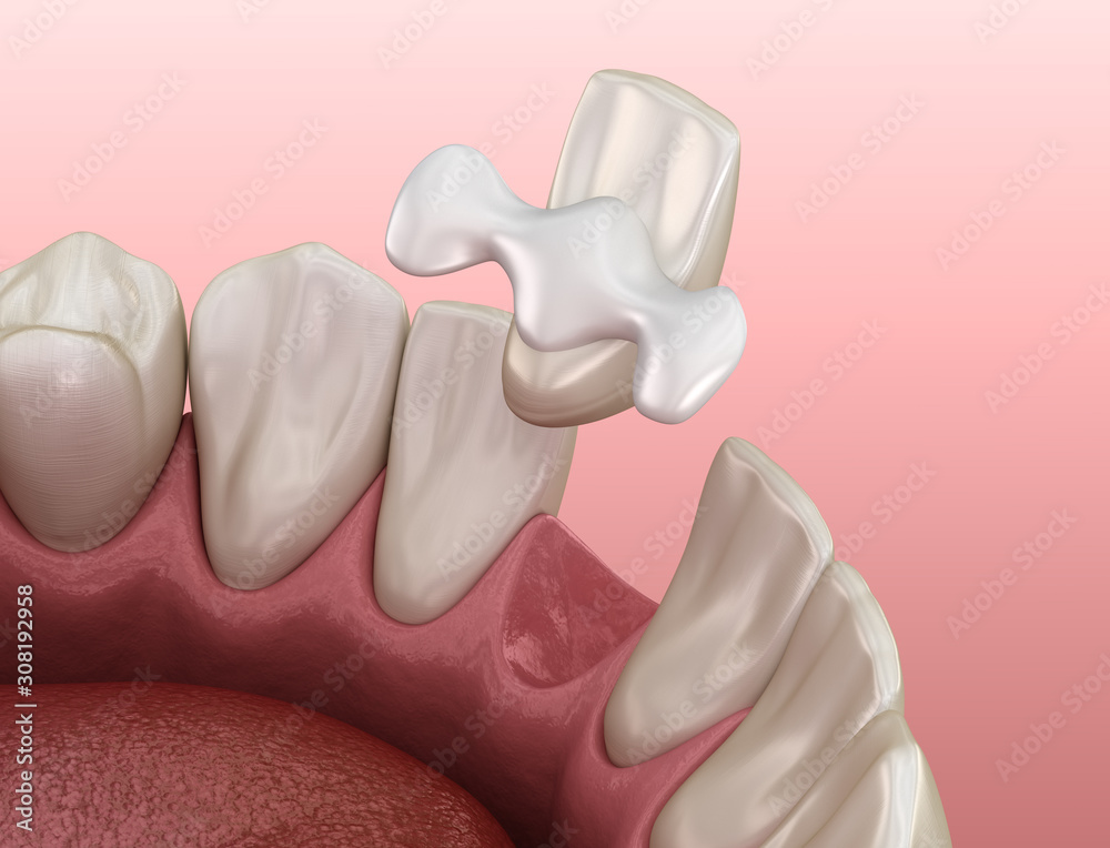 Maryland bridge made from ceramic, front tooth recovery. Medically ...