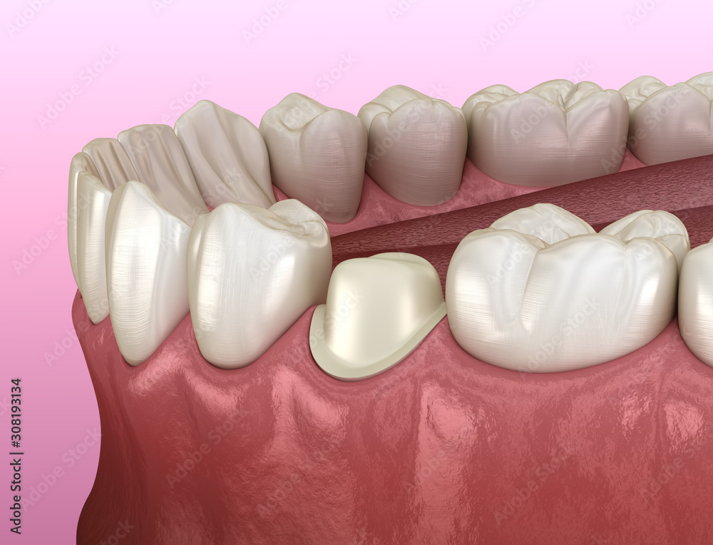 Preparated premolar tooth for dental metal-ceramic crown placement ...