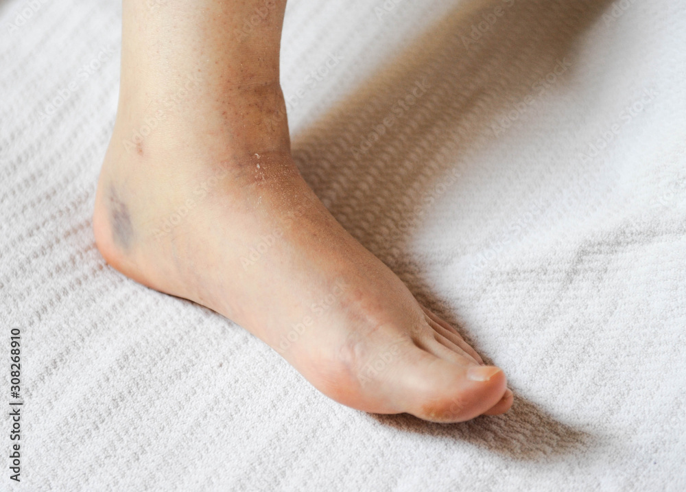 Woman leg injury hematoma after ancle sprain Stock Photo | Adobe Stock