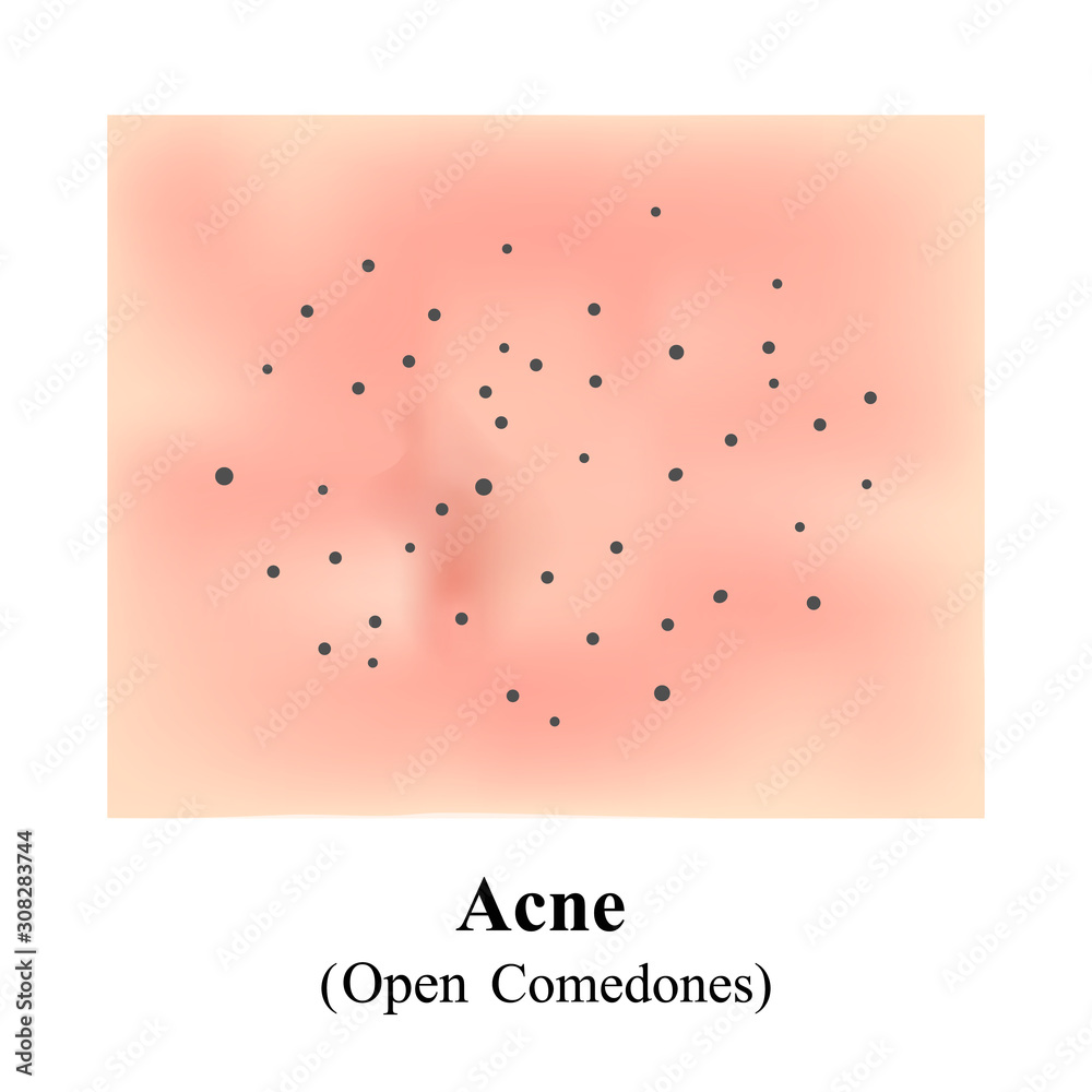Acne Open Comedones Skin With Blackheads Black Spots Acne On The acne-open-comedones-skin-with-blackheads-black-spots-acne-on-the