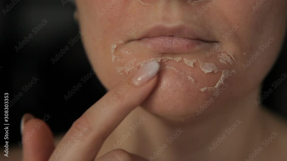 Woman's face after chemical peeling. Peeling skin on the face ...