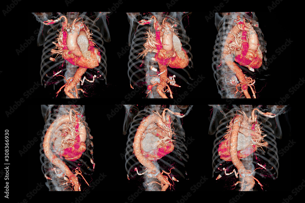 Collection of CTA thoracic aorta 3D rendering image for diagnotic ...