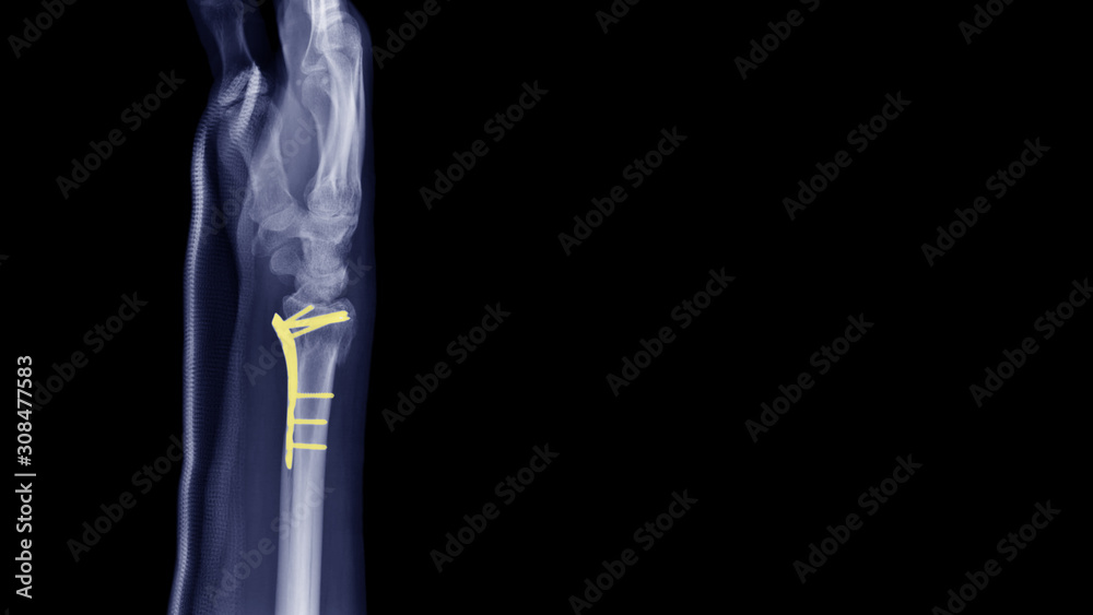 Film X-ray wrist radiograph show lower end of forearm bone broken ...