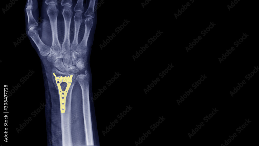 Foto de Film X-ray wrist radiograph show lower end of forearm bone ...