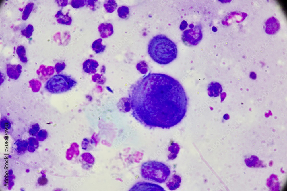 Tzanck Smear Multinucleated Giant Cells
