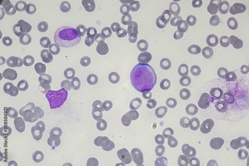 Blast cell (Acute myeloid leukemia in Human) Stock Photo | Adobe Stock