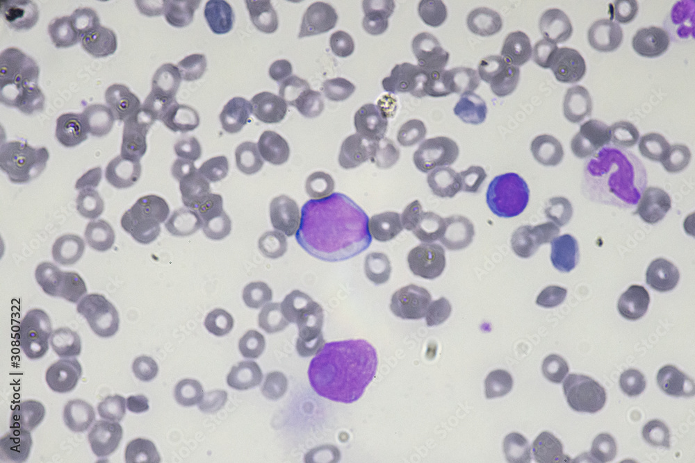 Blast cell (Acute myeloid leukemia in Human) Stock Photo | Adobe Stock