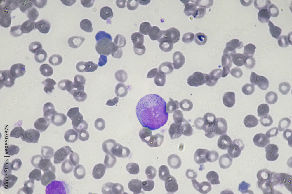 Blast cell (Acute myeloid leukemia in Human) Stock Photo | Adobe Stock
