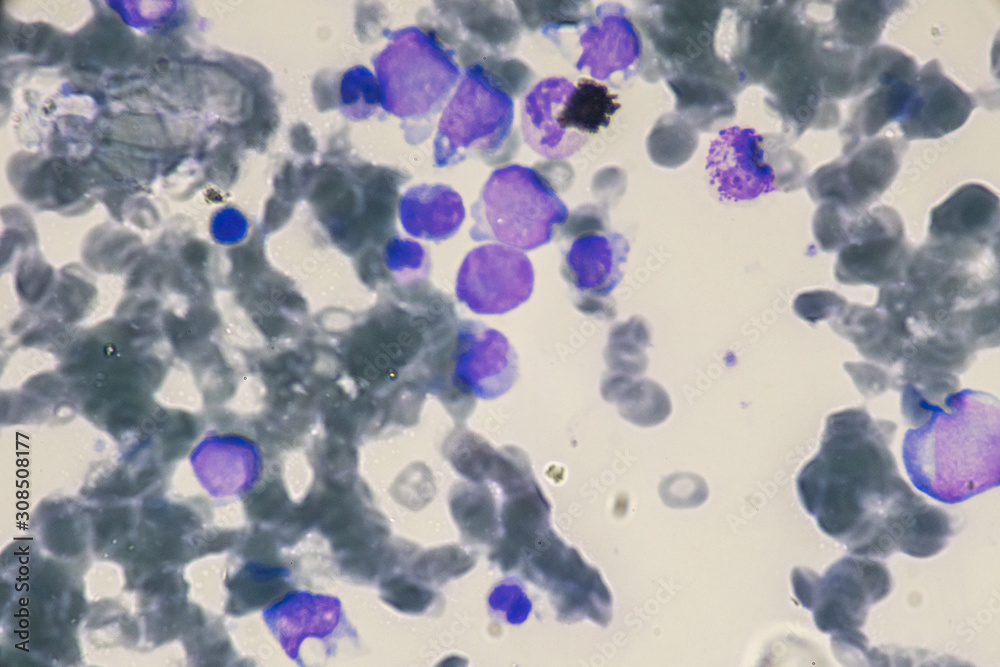 Blast cell in Acute myeloid leukemia from human blood cells (White ...
