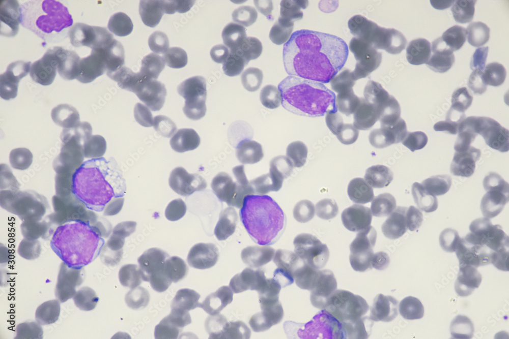 Blast cell in Acute myeloid leukemia from human blood cells (White ...