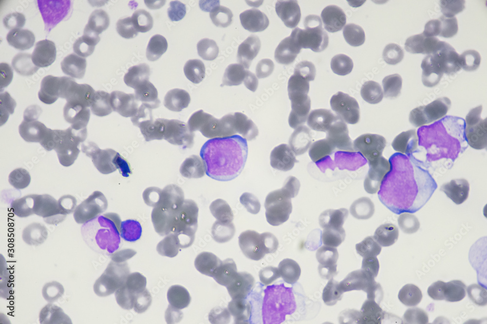 Blast cell in Acute myeloid leukemia from human blood cells (White ...