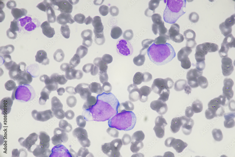 Blast cell in Acute myeloid leukemia from human blood cells (White ...