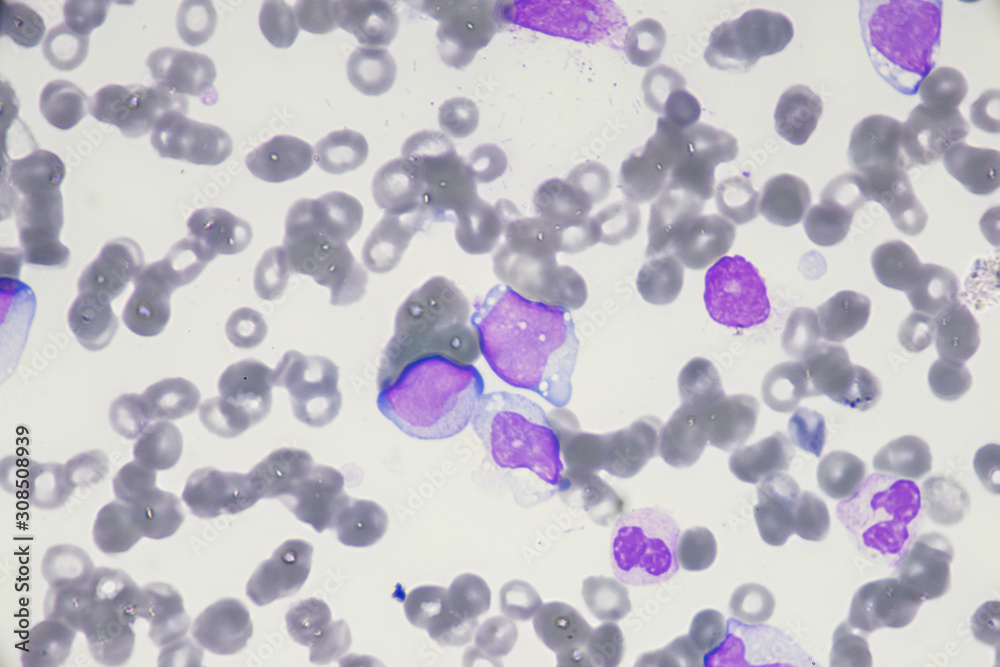 Blast cell in Acute myeloid leukemia from human blood cells (White ...
